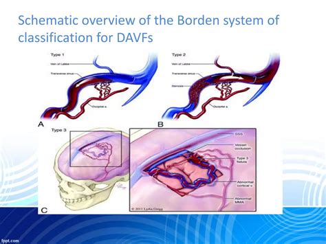 Dural Arteriovenous Fistula And Avm Pptx