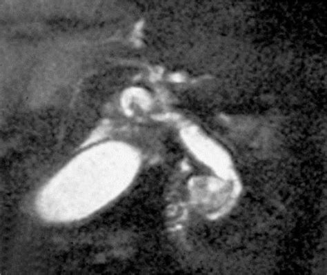 The Diverticulum As Seen On Mrcp Compressing The Distal End Of The Cbd