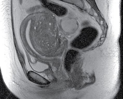 Endometrialjunctional Zone Thickening Clinical Tree