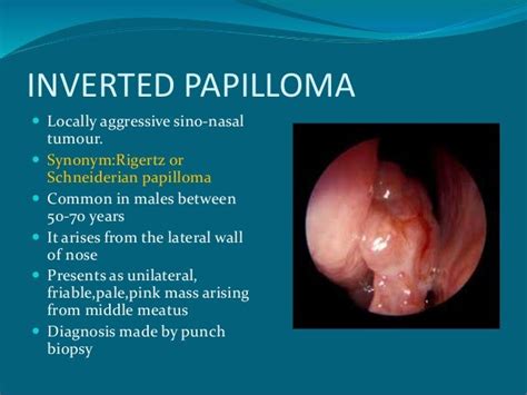 Neoplasms Of Nose And Pns