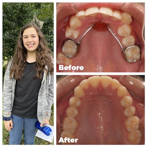 Palatal Expander Results