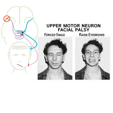 Facial Nerve Palsy Upper Motor Neuron Medical System To Evaluate The