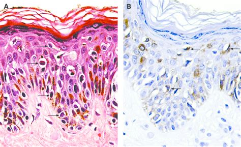 In Situ Melanoma A Atypical Melanocytes Mainly Distributed At The