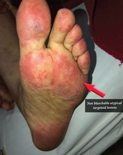 Lupus Rash On Hands Skin Papules Hand Neuropathy And Monoclonal