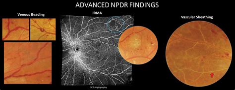Diabetic Eye Disease A Comprehensive Look At The Optometrists Role