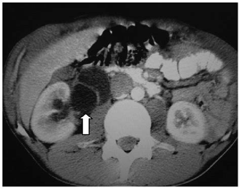 Case 1 Right Hydronephrosis Arrow Download Scientific Diagram
