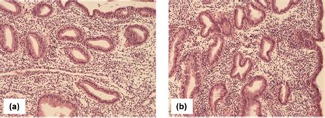 Histological Pictures Of The Endometrium Obtained By Pipelle Sampling