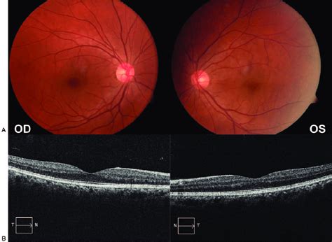 Optic Disc Normal Illustrations
