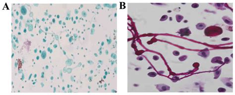 Aspergillus In Liquid‑based Cervicovaginal Cytology In A Postmenopausal