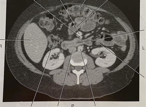 Axial Ct Duodenum Diagram Quizlet