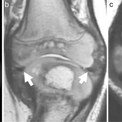 Normal Anterior Cruciate Ligament Acl Anatomy In A 17 Year Old Girl