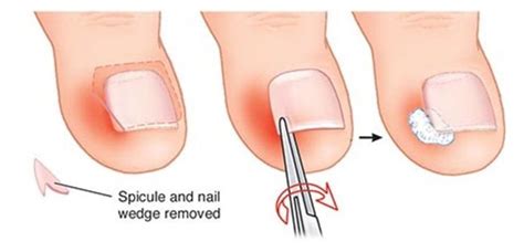 How To Fix Ingrown Toenail Permanently Swissklip