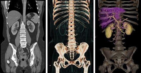 Accumen Acquires Medical Imaging Post Processing Company 3dr Laboratories