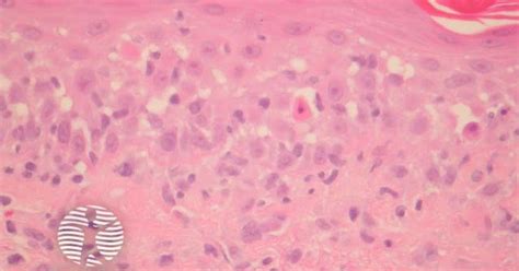 Dermnet® Paraneoplastic Pemphigus Pathology Image