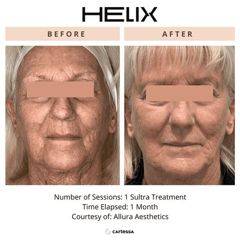 cartessa helix laser resurfacing in ormond beach fl ema
