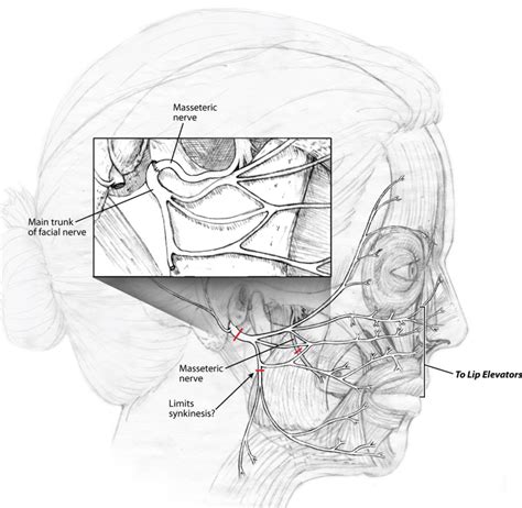 Masseter To Trigeminal Facial Nerve Transfer Dr Azizzadeh Fpi