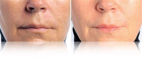 Lpg® Endermolift Skin Rejuvenation Treatment Nova Aesthetic Clinic