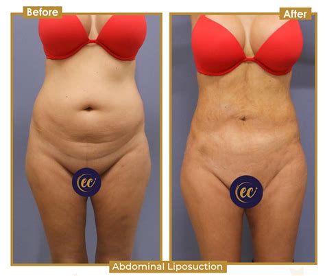 Abdominal Liposuction Estherian Clinic