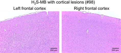 Frontal Cortex Histology Normal High Resolution Tractography Protocol