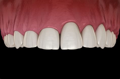 An Introduction To Tooth Contouring Treatment Dr Alex Midtown Nyc