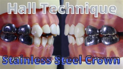 Hall Technique 🔵stainless Steel Crown🟣step By Step🟤 Youtube