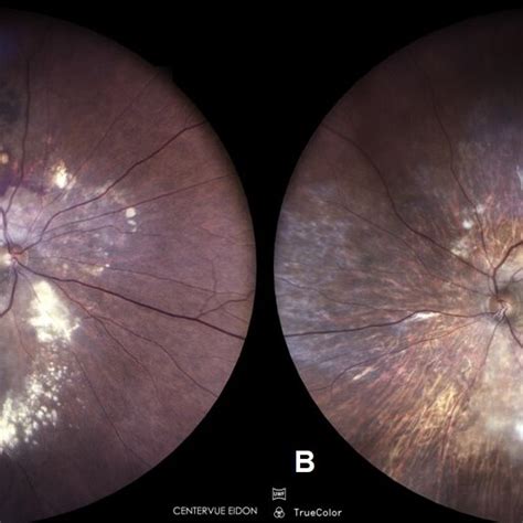 Baseline Images Showing Polyps In Icga A With Corresponding Sd Oct Download Scientific