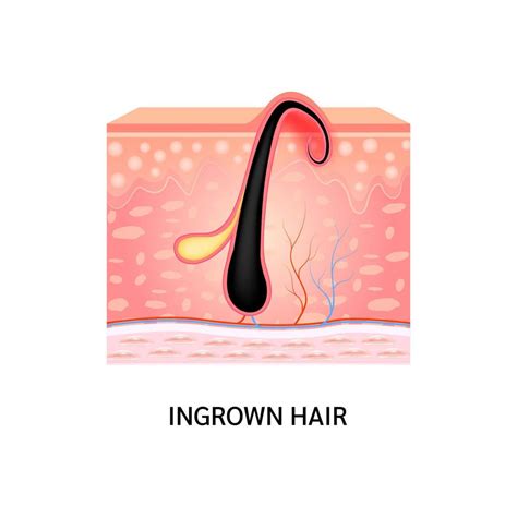 Ingrown Hair Diagram