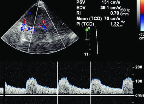 Duplex Doppler Image And Spectral Waveform Show The Velocity Of Blood