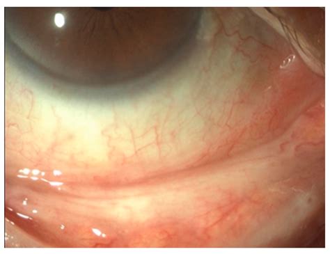 A Quick Surgical Treatment Of Conjunctivochalasis Using Radiofrequencies