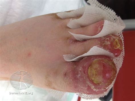 Acrodermatitis Continua Of Hallopeau Ach Is A Rare Inflammatory