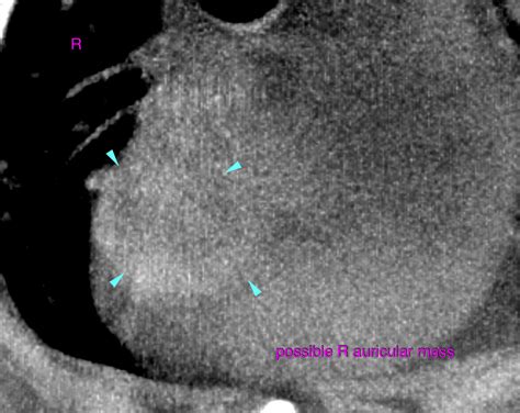 Ct Multifocal Soft Tissue Nodules Of Multiple Organs And Heart Base