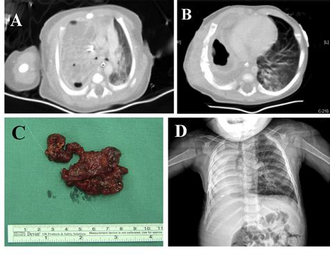 Necrotizing Pneumonia