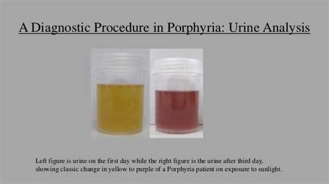 Porphyria