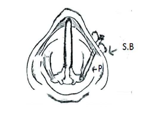 Arytenoid Adduction Technique Muscular Process Of Arytenoid Rotated