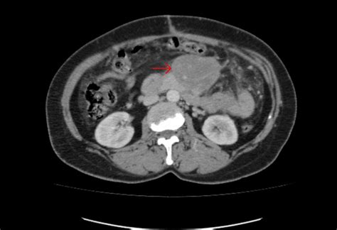 Diagnostic Dilemma Igg4 Related Sclerosing Mesenteritis Mimicking An