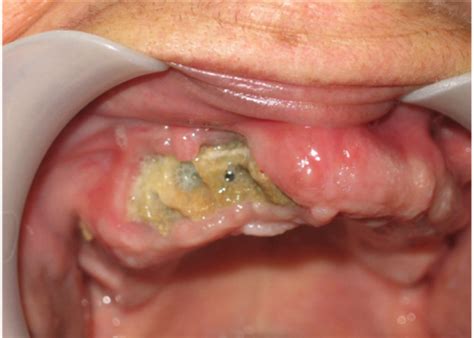 Bone Lesions Inflammatory Flashcards Quizlet