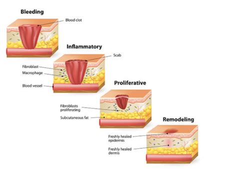 Skin Integrity Envenomation And Arthropod Bite Reactions Flashcards Quizlet