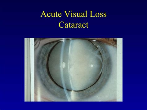 Acute Visual Loss Pdf