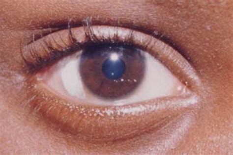 White Spot On Conjunctiva