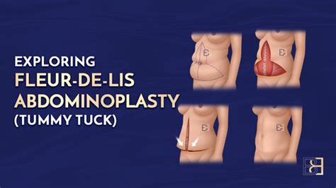 Dr Bbs Guide To Belly Button Umbilicus Beautification And