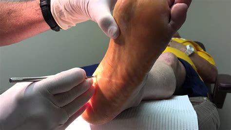 Plantar Fasciitis Surgery By Podiatrist Dr Leo Krawetz Youtube