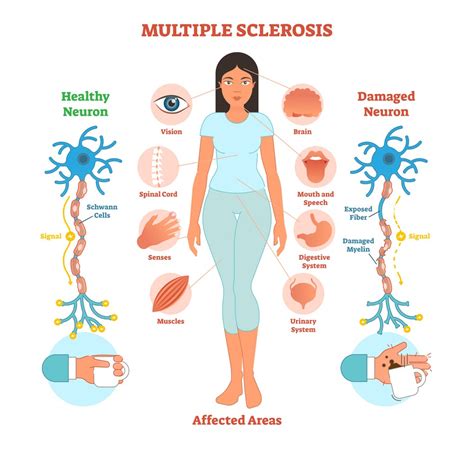 Multiple Sclerosis Ms Causes Treatment Disability