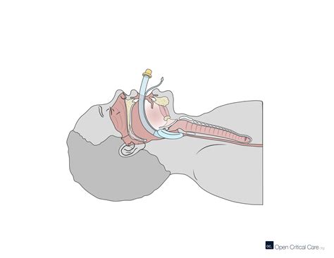 Proper Position Of Laryngeal Mask Airway At Norma Cuellar Blog
