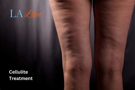 Cellulite Treatment For Women Herefordshire