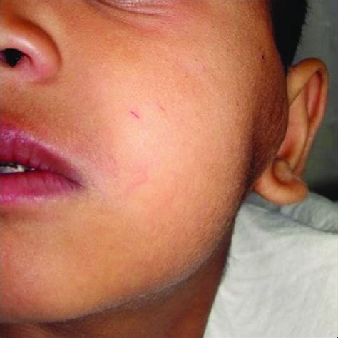 Extra Oral Photograph Revealed A Pre Auricular Swelling On The Left