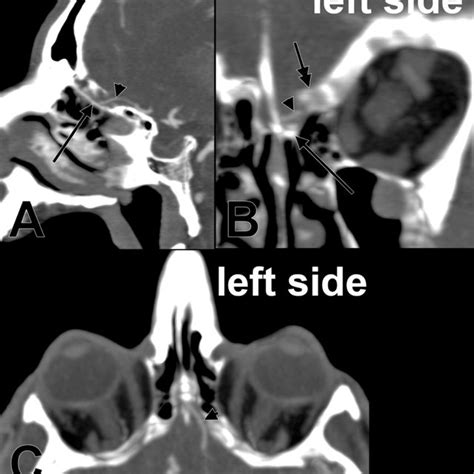 Left Persistent Primitive Olfactory Artery Ppoa Left Lateral View Of