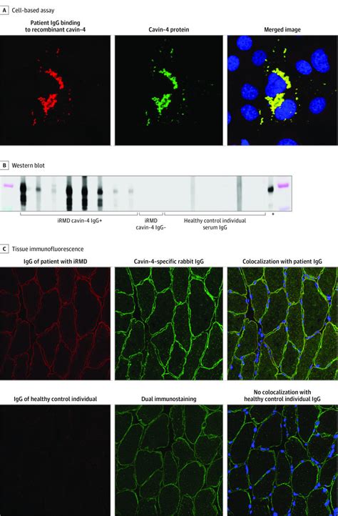 Identification Of Caveolae Associated Protein 4 Autoantibodies As A
