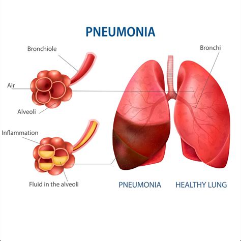 Common Symptoms Of Pneumonia How Can I Prevent It