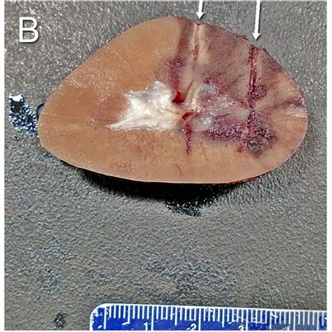 A Biopsy Core Taken From The Ablation Zone Containing Sufficient