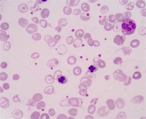A Nucleated Red Blood Cell Or Nrbc Is A Red Blood Cell Rbc T Stock